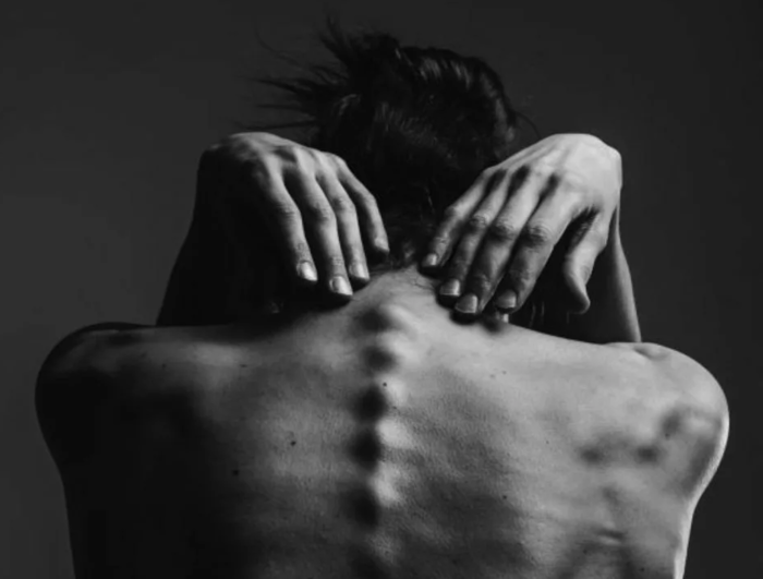 Anorexia: Príznaky, príčiny a možnosti liečby